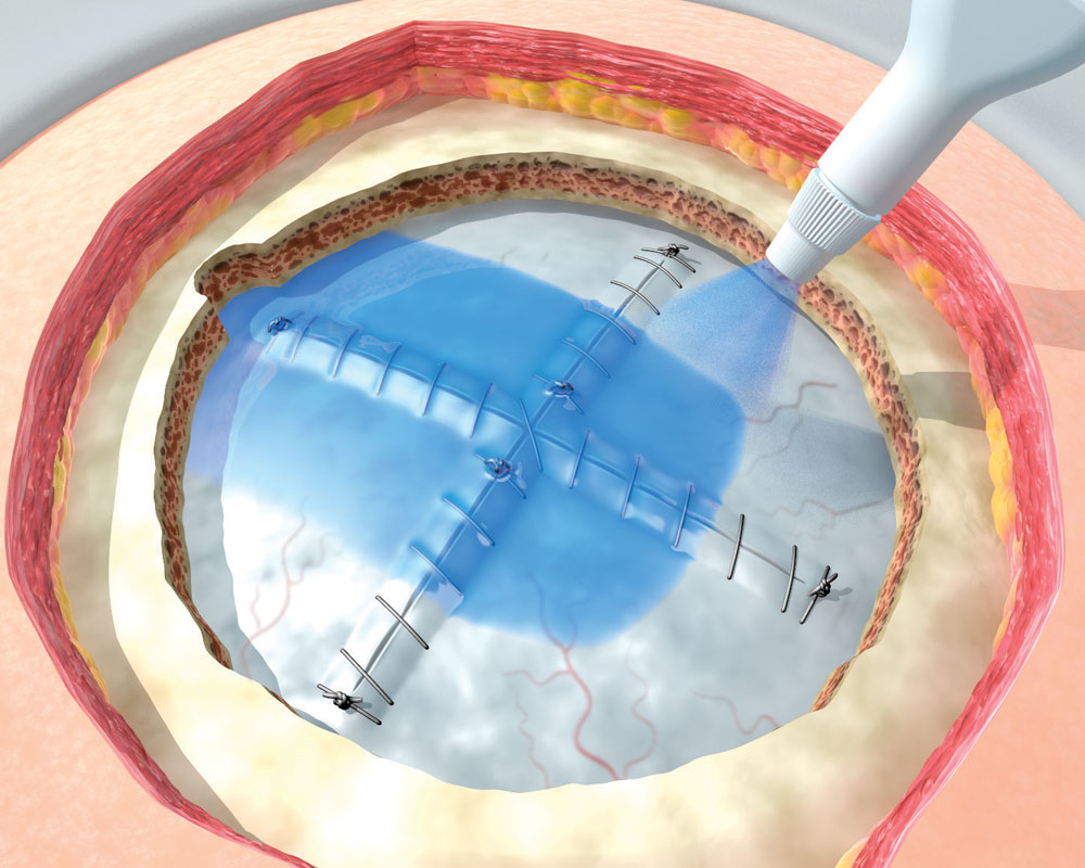 DuraSeal Dural Sealant System