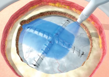 DuraSeal Dural Yapıştırıcı